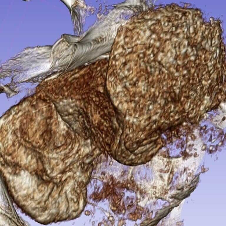 Ancient Egyptian fetus preserved due to unusual decomposition process